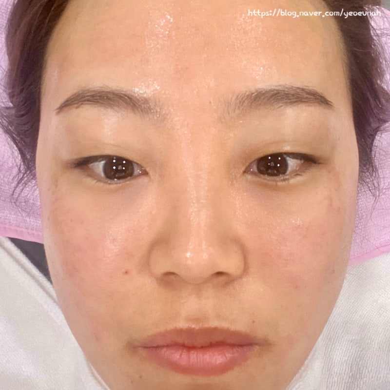 강남 듀얼토닝 기미 잡티 레이저후기 네이버 블로그