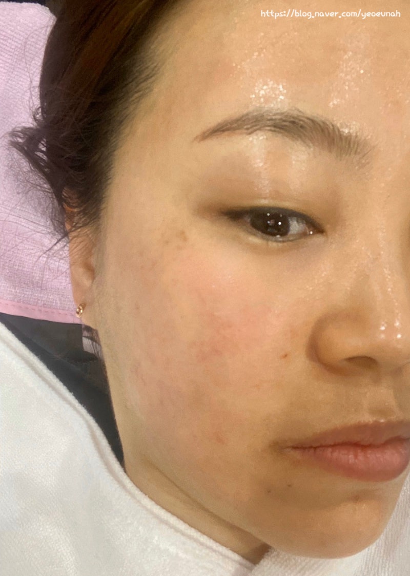 강남 듀얼토닝 기미 잡티 레이저후기 네이버 블로그