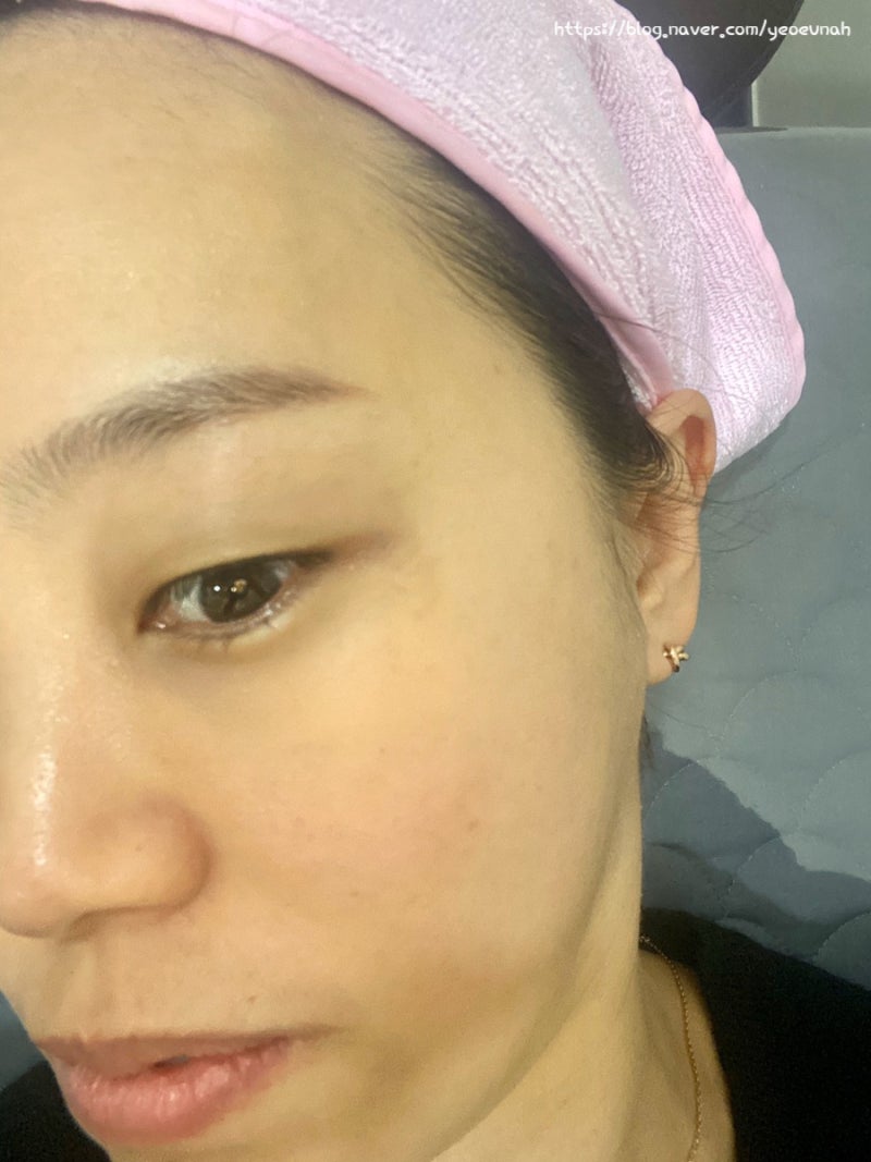 강남 듀얼토닝 기미 잡티 레이저후기 네이버 블로그
