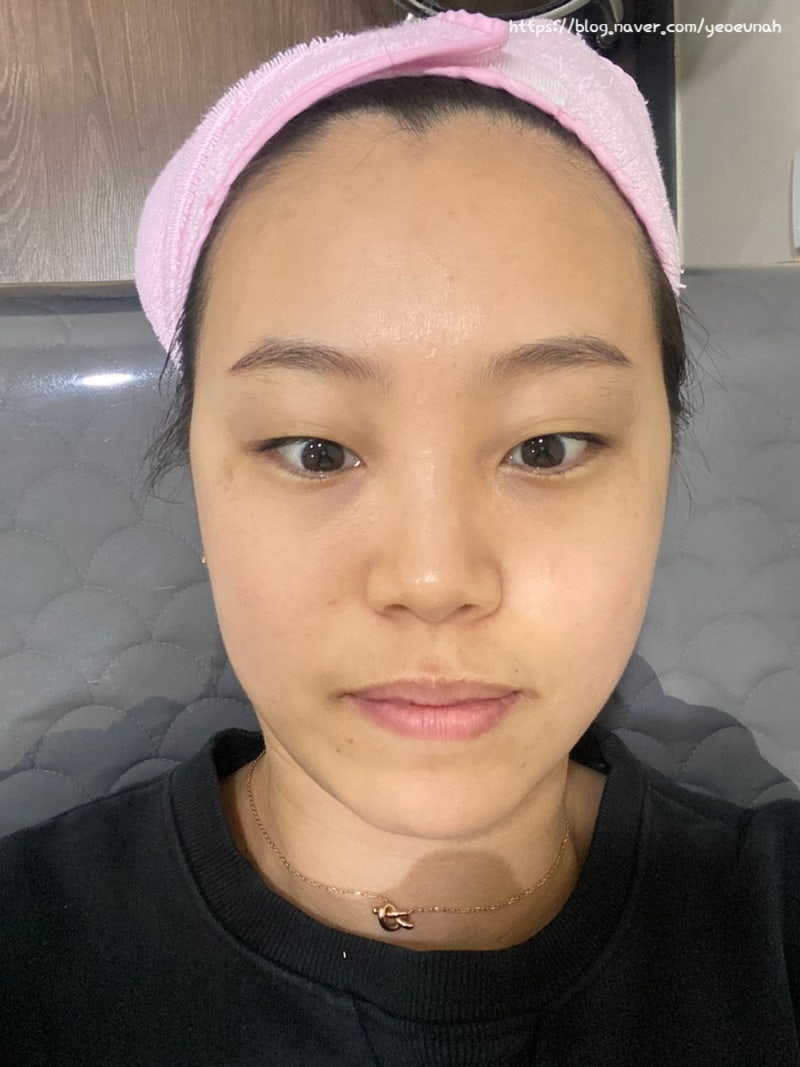 강남 듀얼토닝 기미 잡티 레이저후기 네이버 블로그