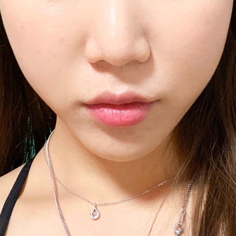 안면윤곽주사후기 지방파괴주사 1회차 솔직후기효과 통증 멍 붓기 네이버 블로그