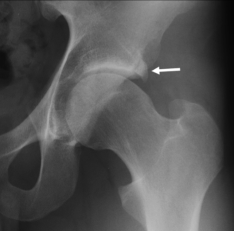 대퇴충돌증후군의 비수술적 치료는? (FAI, Warwick Consensus Statement) : 네이버 블로그