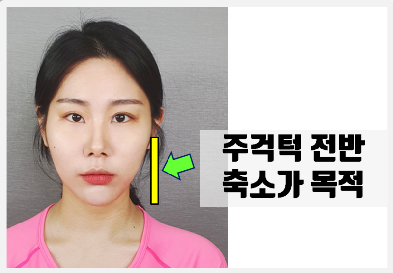 긴 얼굴 짧아보이는 주걱턱 교정 주걱턱 교정운동 아래턱이 긴 얼굴 마사지 해부학적처방리샘자가교정 13탄 네이버 블로그