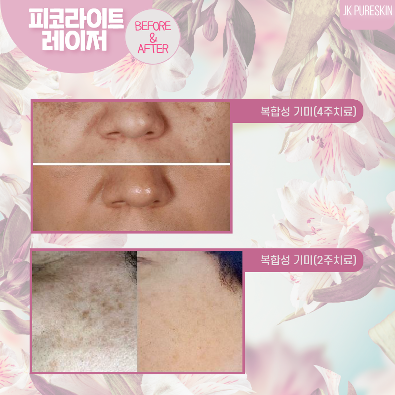 PICOLITE :: 피코라이트 레이저 : 네이버 블로그