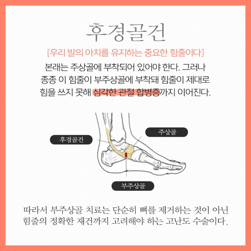 복숭아뼈 통증의 부주상골증후군은 왜 후천성 평발의 원인이 될까 네이버 블로그