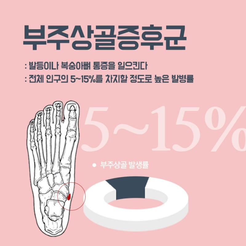 복숭아뼈 통증의 부주상골증후군은 왜 후천성 평발의 원인이 될까 네이버 블로그