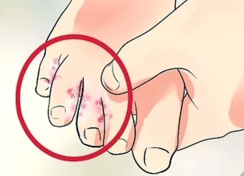 닥터펠프스~ 지긋지긋한 발 무좀 좀 제발 없애주세요 무좀약 무좀연고 항진균제 네이버 블로그