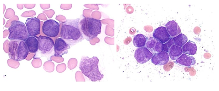 Acute promyelocytic leukemia, overview : 네이버 블로그