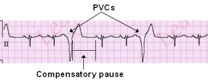 이상 심전도 - 심실조기수축(premature ventricular contraction, PVC) : 네이버 블로그