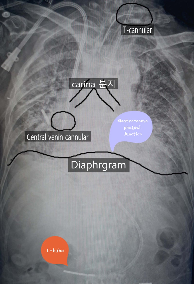 [Rn] L-tube 비위관 튜브 (Nasal-gastric , Nasal duodeno, nasojejunal),경장영양 간호 ...