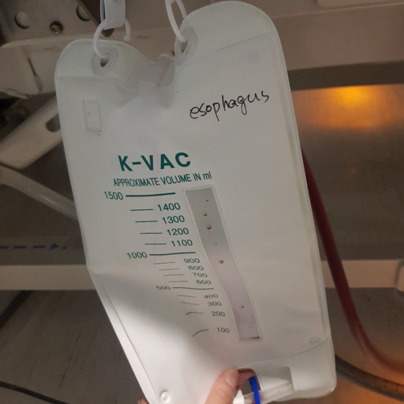 식도정맥류 출혈 치료 - SB tube(Sengstaken-Blakemore tube) : 네이버 블로그