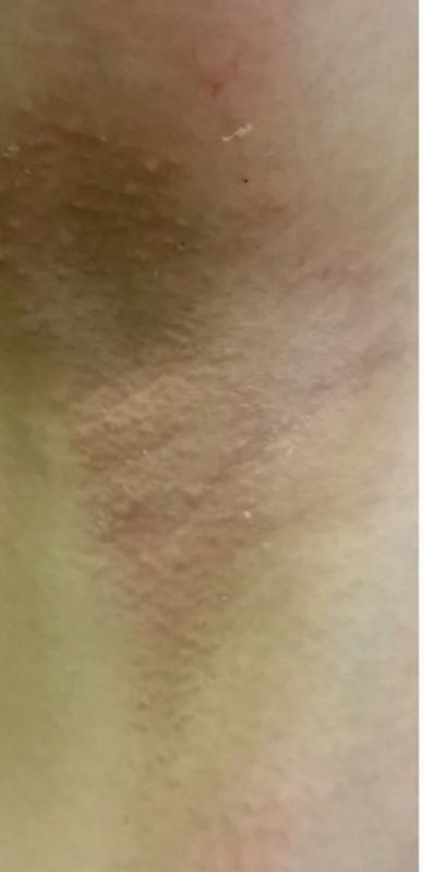 선릉역피부과 여의사피부과전문의 겨드랑이착색레이저유두색소침착브라질리언미백y존미백팔꿈치토닝 확실한 후기삼성동피부과