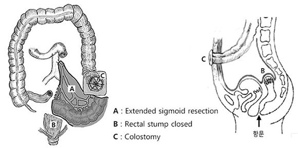 Hartmann operation, Hartmann procedure, 하트만 수술 : 네이버 블로그