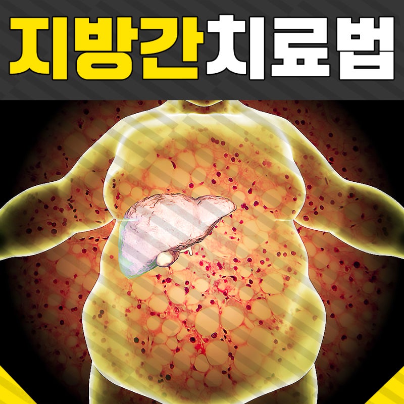 지방간에 좋은 음식 콜레스테롤 혈증 증상 간 수치 원인 운동 치료 영양제 성분 네이버 블로그