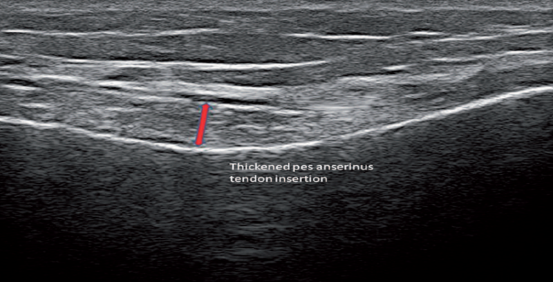 Pes anserine bursitis(거위발점액낭염) / tendinitis(거위발건염) : 네이버 블로그