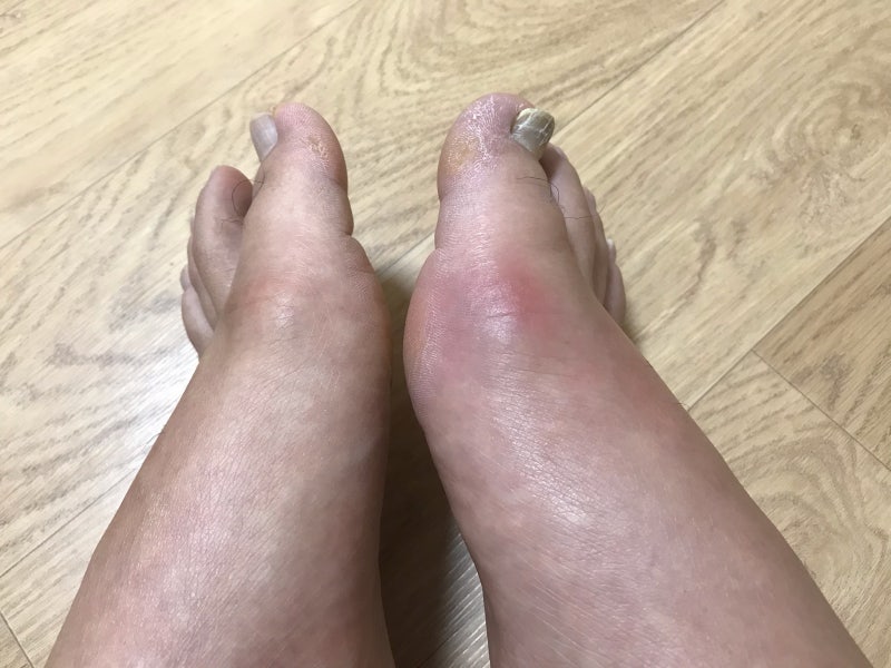 통풍 발작 다음 극심한 발목 통증 통풍 정의 증상 원인 혈액검사 결과 약처방 주의할 음식 치료법 네이버 블로그