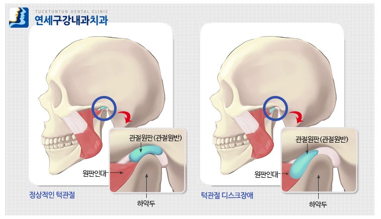 악관절 통증 턱관절에서 나타나는 증상의 원인과 치료방법 네이버 블로그