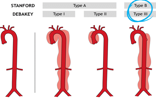 Aortic dissection (stanford B, Debakey IIIb) : 네이버 블로그