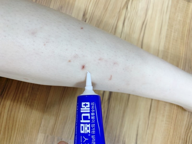 오래된 흉터 제거위해 구매해본 메디폼 스카겔 더마틱스 울트라 흉터연고 네이버 블로그
