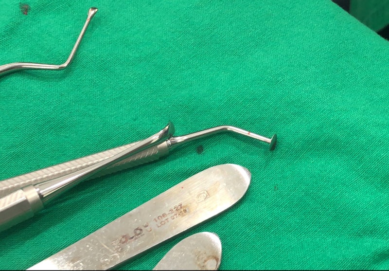 치과위생사의 하루 상악동 거상술 수술 처음 본 날 측방접근법 Lateral Approach 네이버 블로그