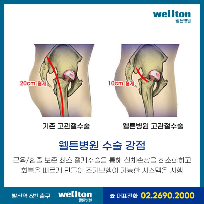 뼈가 죽는 병 대퇴골두 무혈성 괴사 치료 방법은 네이버 블로그