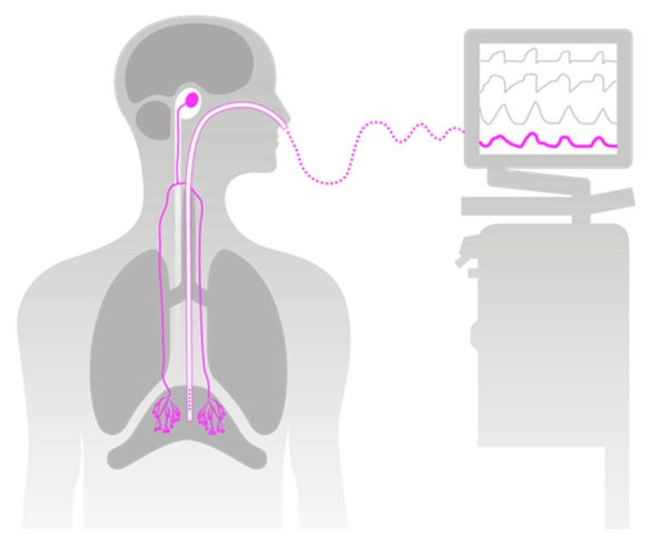 NAVA (Neurally Adjusted Ventilatory Assist) : 네이버 블로그