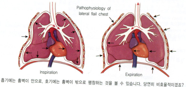 Flail Chest Diagram