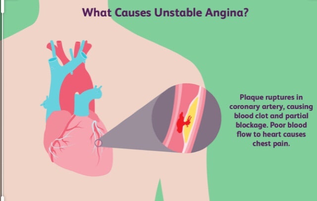 Q6. 가슴 통증(흉통)의 원인,위치,증상에 대하여 알아봅니다. : 네이버 블로그