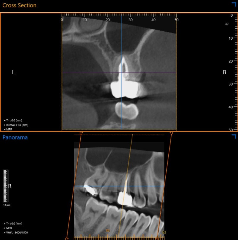 치성상악동염의 진단과 치료 (Sinusitis by Endo-Origin) : 네이버 블로그