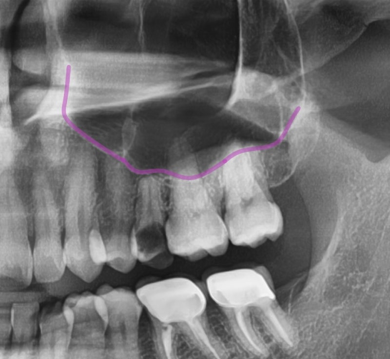 치성상악동염의 진단과 치료 (Sinusitis by Endo-Origin) : 네이버 블로그