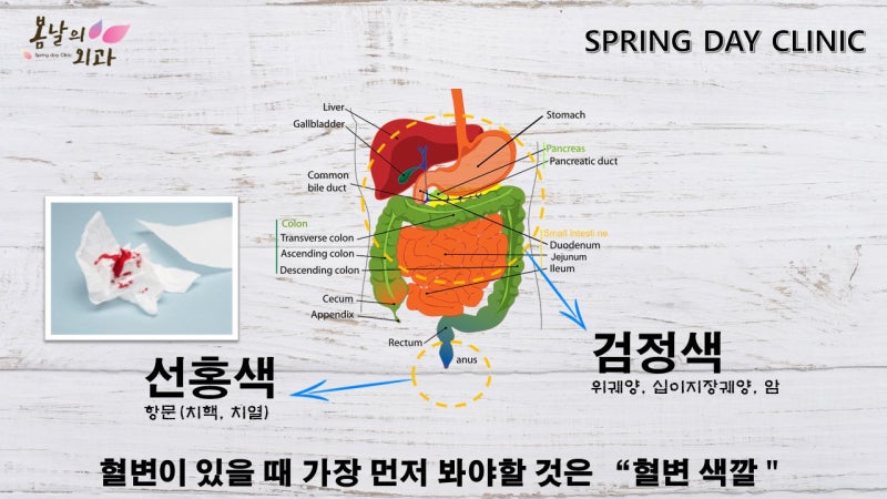 항문출혈혈변 그런데 통증이 없다고 바로 이것이 치질증상 네이버 블로그