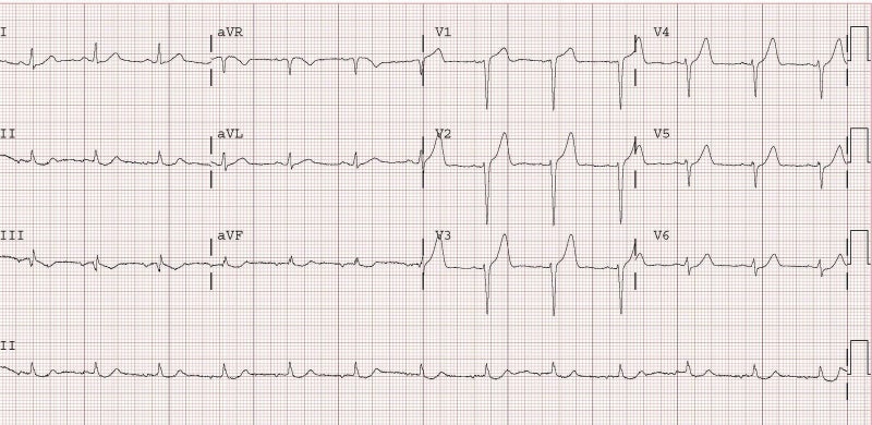 심전도의 해석2 (STEMI, NSTEMI) : 네이버 블로그