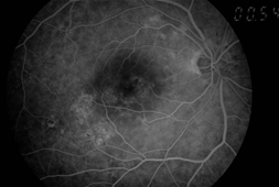 망막질환 정리 - 유의한 황반 부종 (Clinically Significant Macular Edema) CSME : 네이버 블로그
