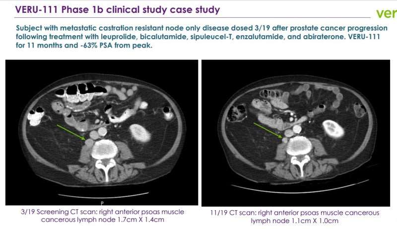 전립선암에 대한 신약, veru-111 : 네이버 블로그