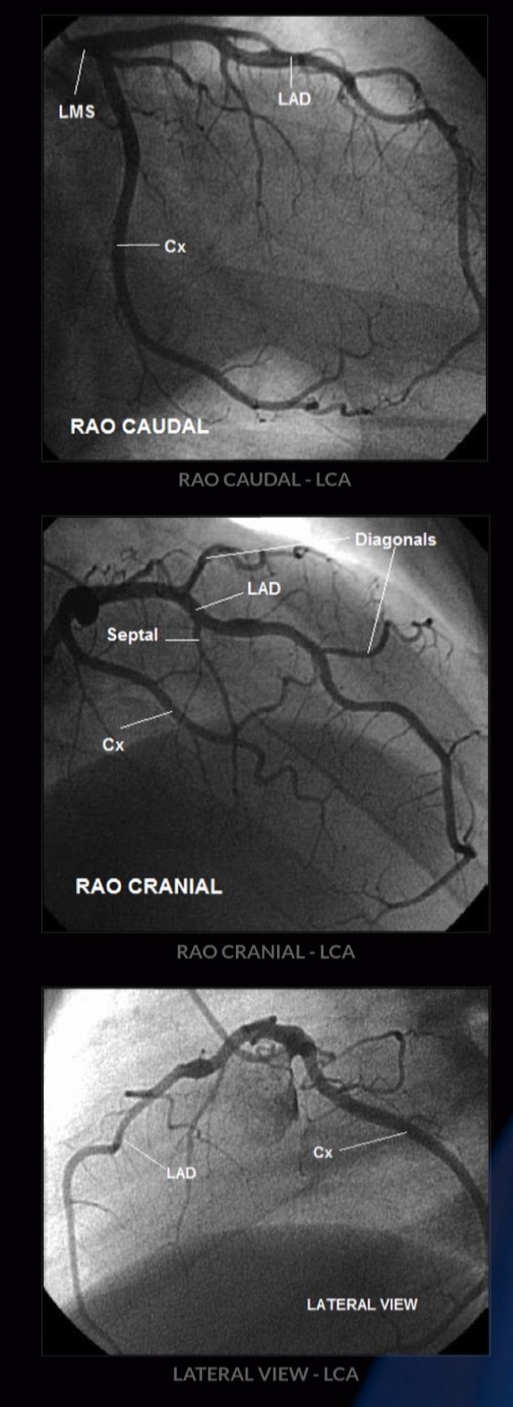 CAG(coronary angiography) 관상동맥조영술 : 네이버 블로그