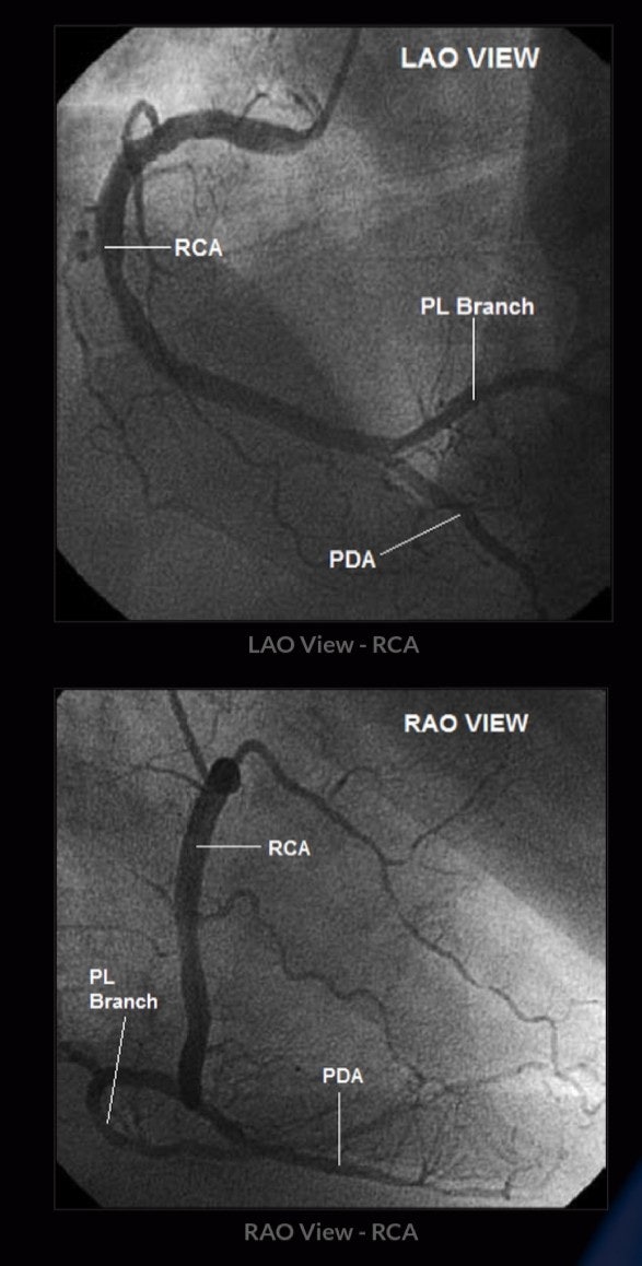 CAG(coronary angiography) 관상동맥조영술 : 네이버 블로그