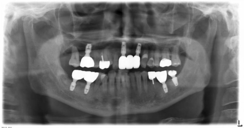 Well Lock 웰락 (Bicon type) 프레미엄 임플란트 : 네이버 블로그