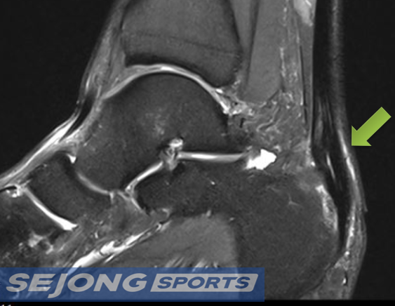 아킬레스 부착부 파열 (Feat. John Wall vesion, Haglund 변형이란?) : 네이버 블로그