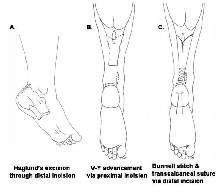 아킬레스 부착부 파열 (Feat. John Wall vesion, Haglund 변형이란?) : 네이버 블로그