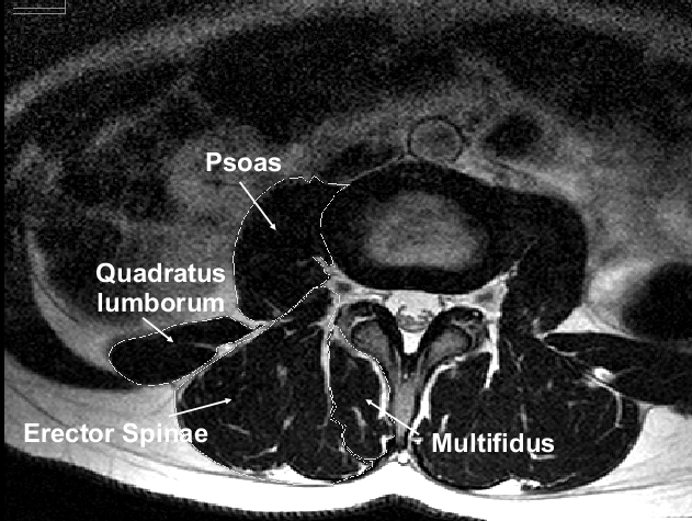 [성신여대한의원]MRI를 통하여 살펴보는 요추의 해부학적 구조 - Transverse plane : 네이버 블로그