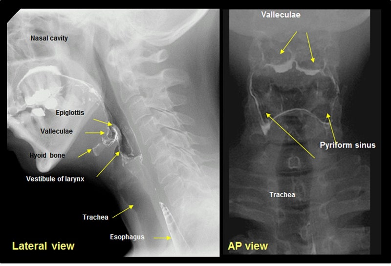 VFSS검사에 관하여 : 네이버 블로그
