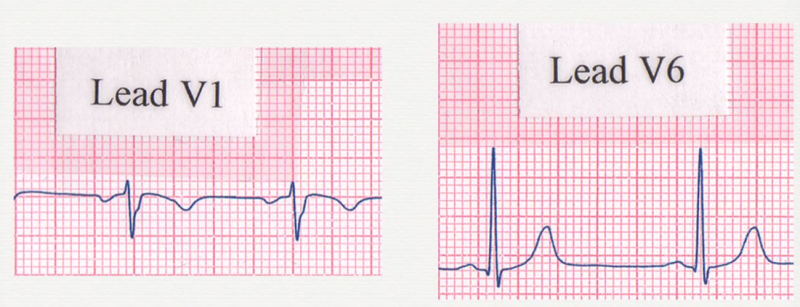 응급의학과 예습 (2) : ECG 기본 : 네이버 블로그