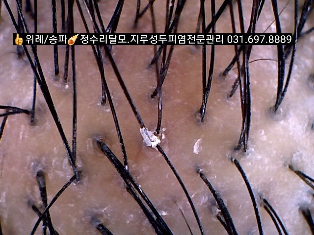 🚨가르마탈모😭지성두피염증🚫떡진머리📌가려운지성두피관리법☄정수리여성탈모🆗️위례탈모개선🎁위례국제두피전문관리사운영
