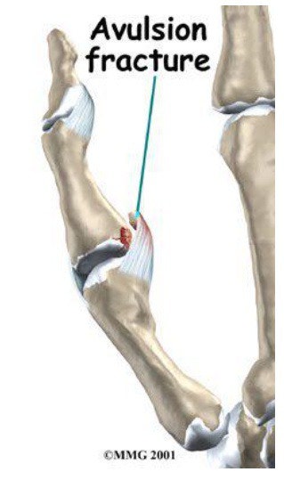 UCL repair & RCL repair (Thumb) : 네이버 블로그