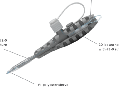 UCL repair & RCL repair (Thumb) : 네이버 블로그