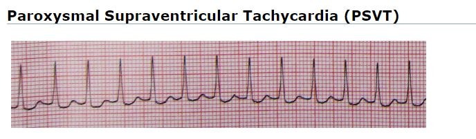 Paroxysmal Supraventricular Tachycardia Ecg