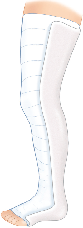 splint 종류 : 네이버 블로그