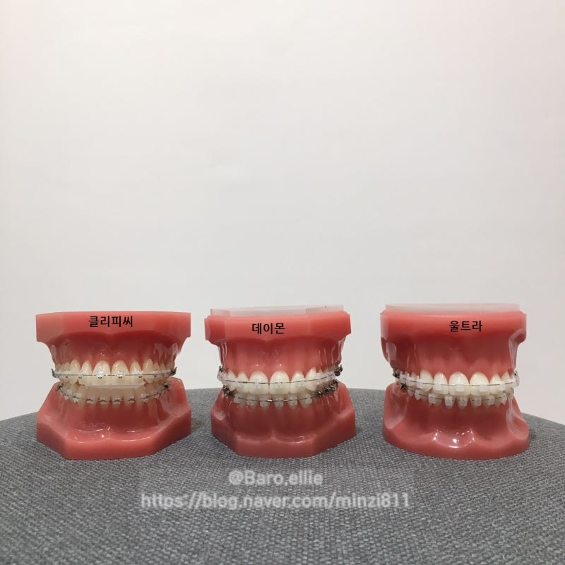 치과 이야기) 브라켓(2)_클리피씨(clippy-c), 데이몬(damon), 3M울트라(ultra) : 네이버 블로그