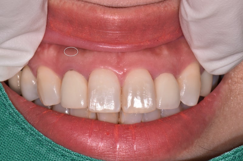 아래앞니 하악전치 2근관 실패하기 쉬운 신경치료 위앞니 치근단절제술 apicoectomy MTA역충전 : 네이버 블로그