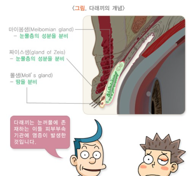 눈다래끼 전염될까 다래끼 초기 증상 및 치료법 네이버 블로그